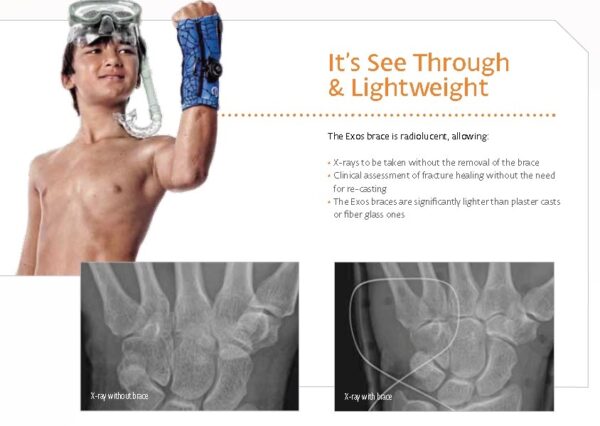 EXOS Casting system for wrist and arm fractures. | PhysioCentral